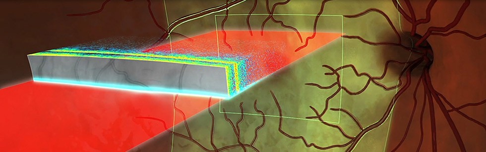 Optical Coherence Tomography (OCT) – Iworks Laser & Vision Center